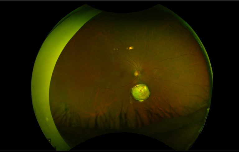 Digital Fundus Photography - Macula Retina Vitreous Center