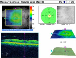 Optical Coherence Tomography – Macula Retina Vitreous Center