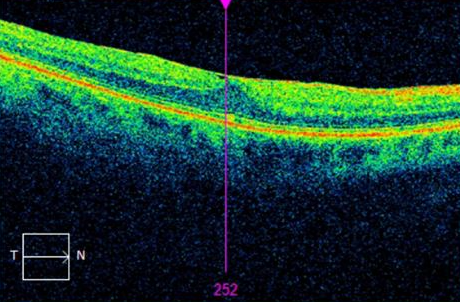 Current Clinical Trials - Macula Retina Vitreous Center